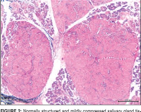 Figure 4 From Potential Trapping Lesion Of The Parotid Gland Multi