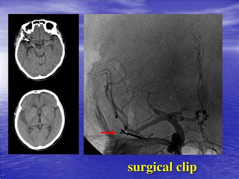 Ppt Subarachnoid Hemorrhage Powerpoint Presentation Free Download