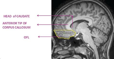 Anatomical Landmarks Of Orbitofrontal Lobe Ofl In Medial Sagittal