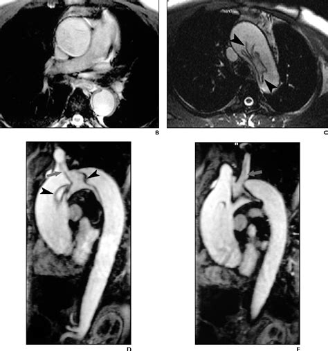 Figure 1 From Acute Aortic Dissection With Intimal Intussusception Mri