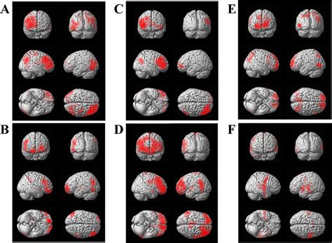 Statistical Parametric Maps Of Brain Regions Where Decreases Of