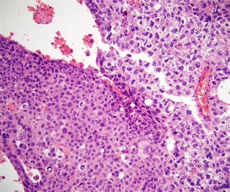 Testicular Choriocarcinoma Ultrasound