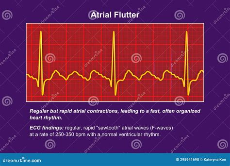 Ecg In Atrial Flutter An Abnormal Heart Rhythm Characterized By Rapid