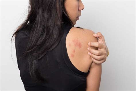 ¿qué Es La Urticaria Crónica Y Cómo Se Trata