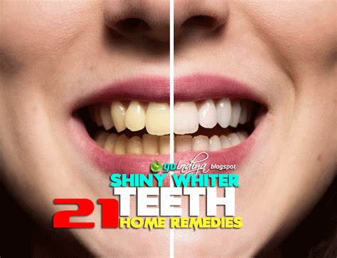 How To Whiten Extremely Yellow Teeth In 15 Days 21 Teeth Whitening