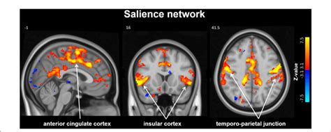 Figure E Salience Network Identified By Resting State Analysis The