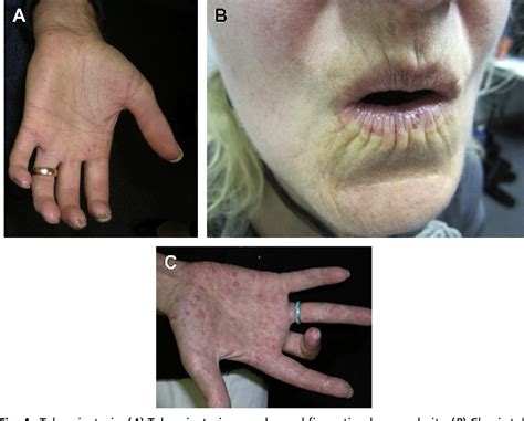 Table 2 From New Classification Criteria For Systemic Sclerosis