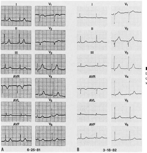 Image result for PR Interval Abnormalities