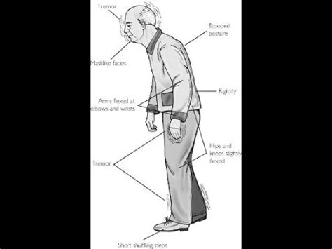 Image result for Extrapyramidal Signs