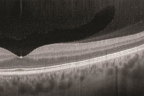 Image result for Oct Interpretation