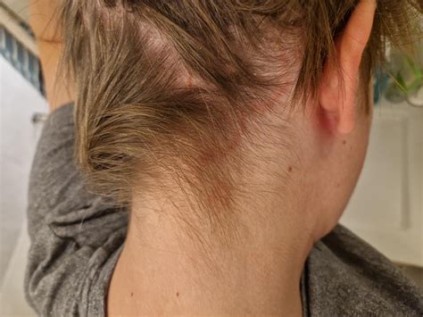 Image result for Seb Derm