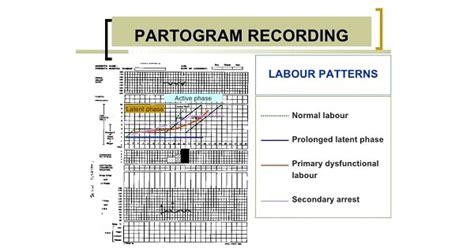 Image result for Partogram Design