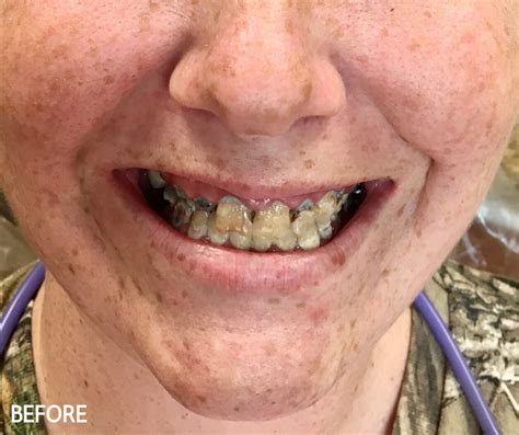 Snap in Dentures - Custom Dental of Atoka | Atoka OK