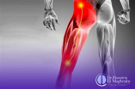9 Sciatica Treatment Options for Severe Spinal Pain | DISC - My Share