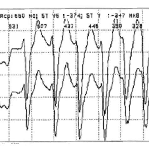 Image result for Types of ST Depression