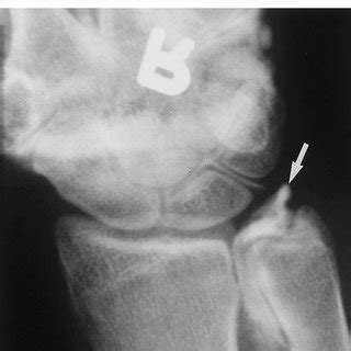 Image result for Wrist Arthrogram