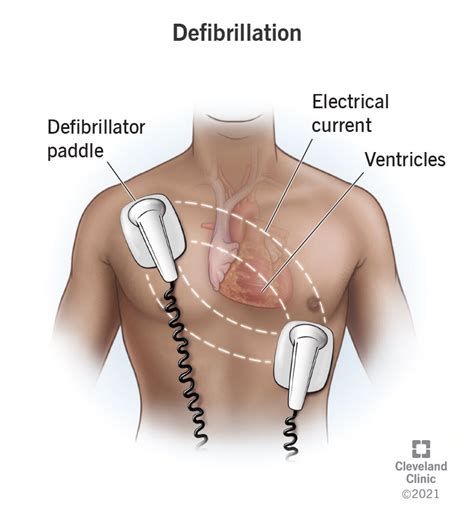 Image result for Defibrillation