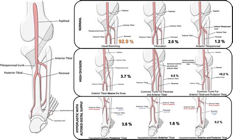 Image result for Left Lower Extremity Angiogram