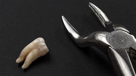 Image result for Wisdom Tooth Overlap