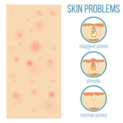 Image result for Threading Rash