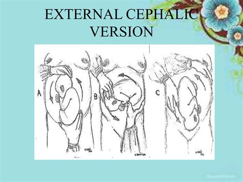 Image result for External Cephalic Version Step by Step