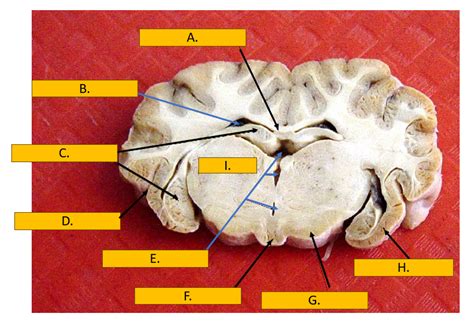 Image result for Brain Dissection