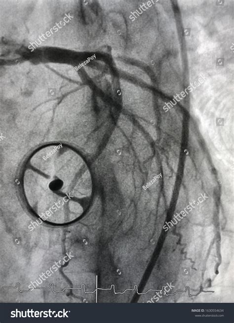Image result for Normal Coronary Angiogram