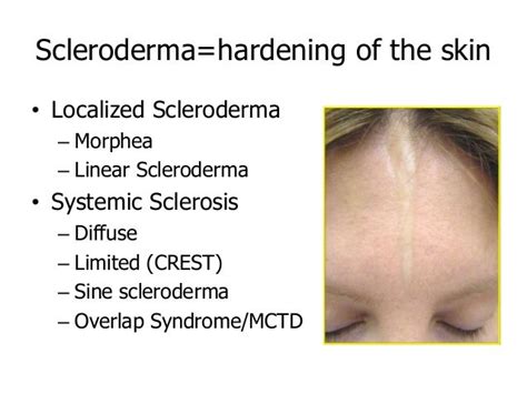 Image result for Scleroderma Skin