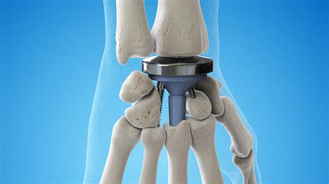 Image result for Hand Surgery Procedure