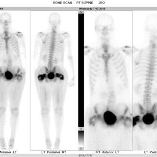 Image result for Triple Phase Bone Scan
