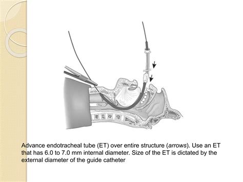Image result for Retrograde Intubation