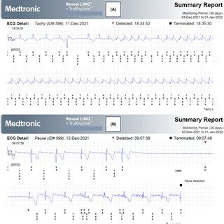 Image result for Atrial Flutter Loop Recorder