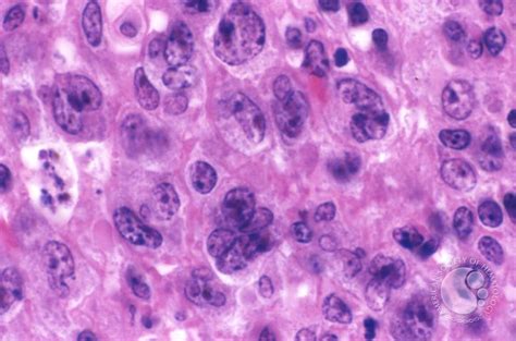 Image result for Diffuse Large Cell Lymphoma