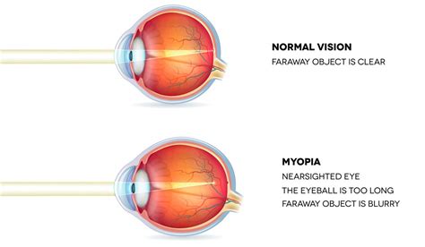 Image result for Vision Defects Myopia