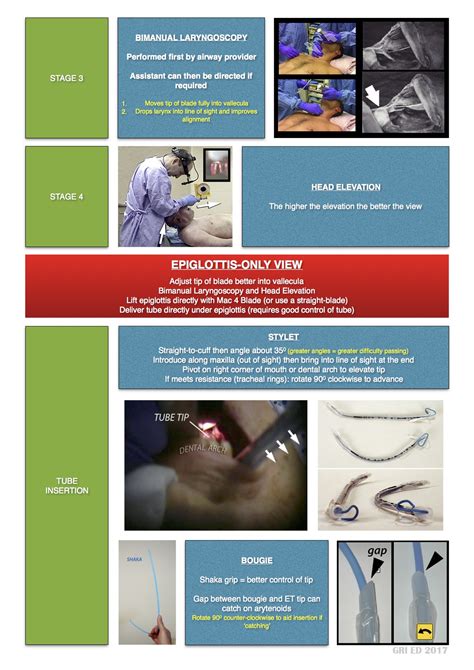 Image result for How to Intubation