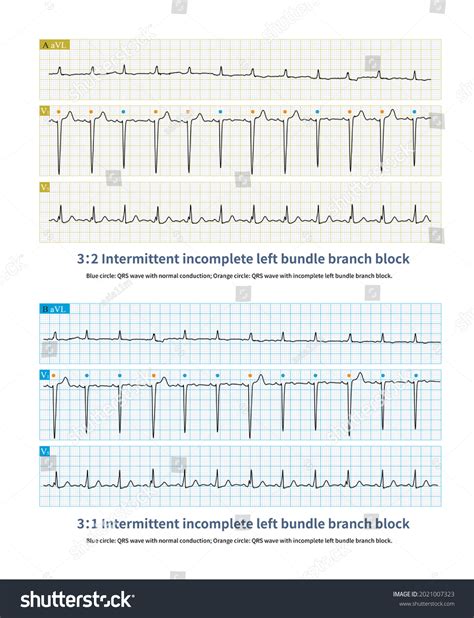 Image result for Incomplete Bundle Branch Block Left Treatment