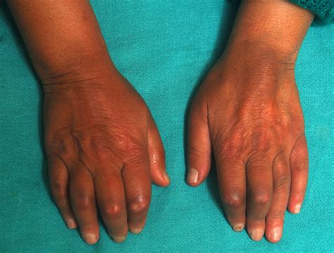 Image result for Scleroderma Skin