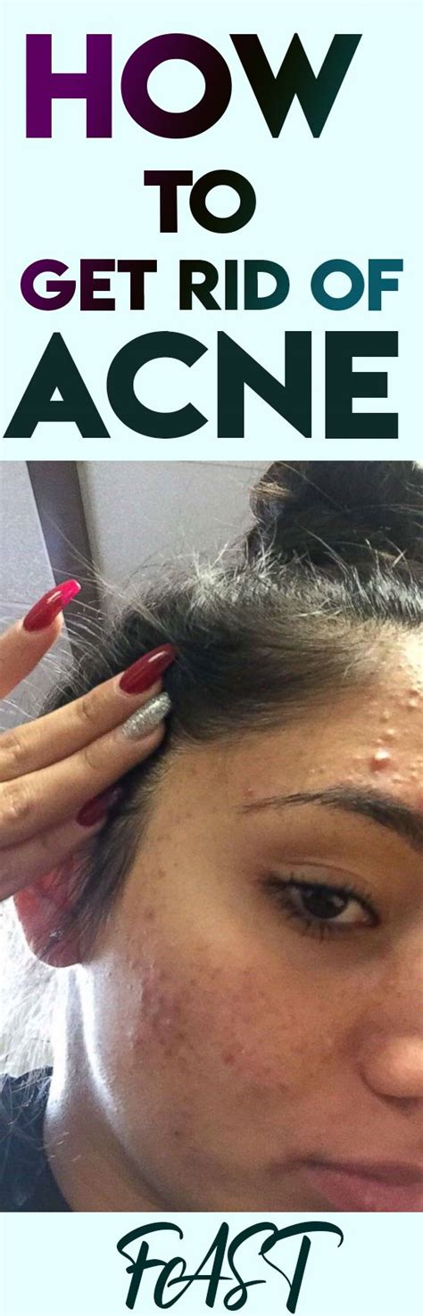 Image result for Threading Rash