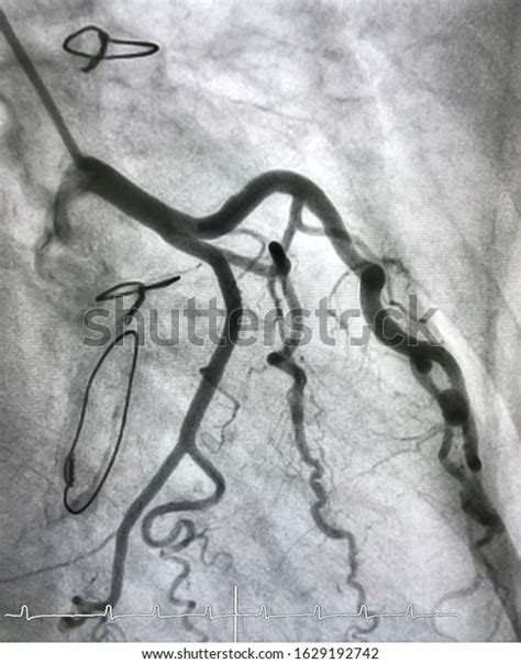 Image result for Normal Coronary Angiogram