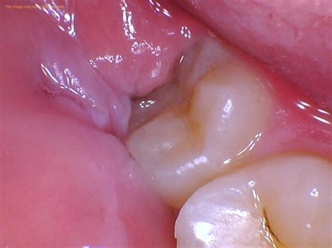 Image result for Wisdom Tooth Overlap