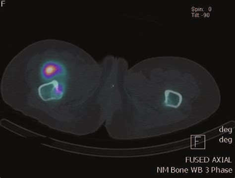 Image result for Triple Phase Bone Scan