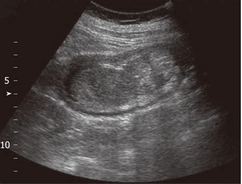 Image result for Intussusception Pseudokidney Sign
