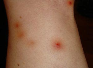 Image result for Cockroach Bites On Humans