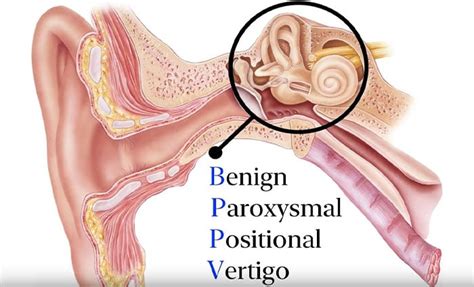 Image result for Positional Vertigo