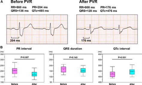 Image result for PR Interval Abnormalities