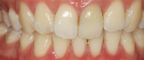 Image result for How to Remove Midline