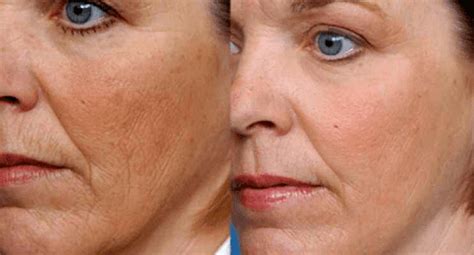 Image result for Micro Resurfacing