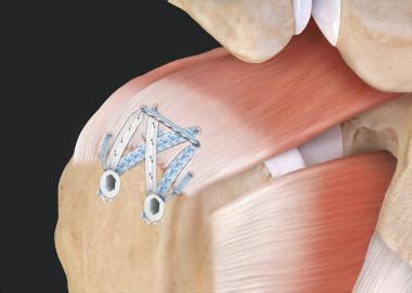 Image result for Rotator Cuff Repair Surgery