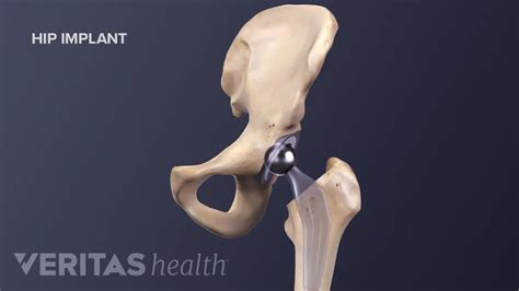 Image result for Hip-Replacement Post Operative Care