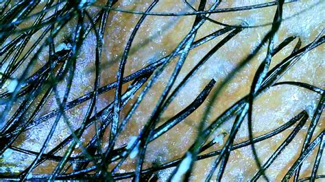 Image result for Seborrhea Capitis